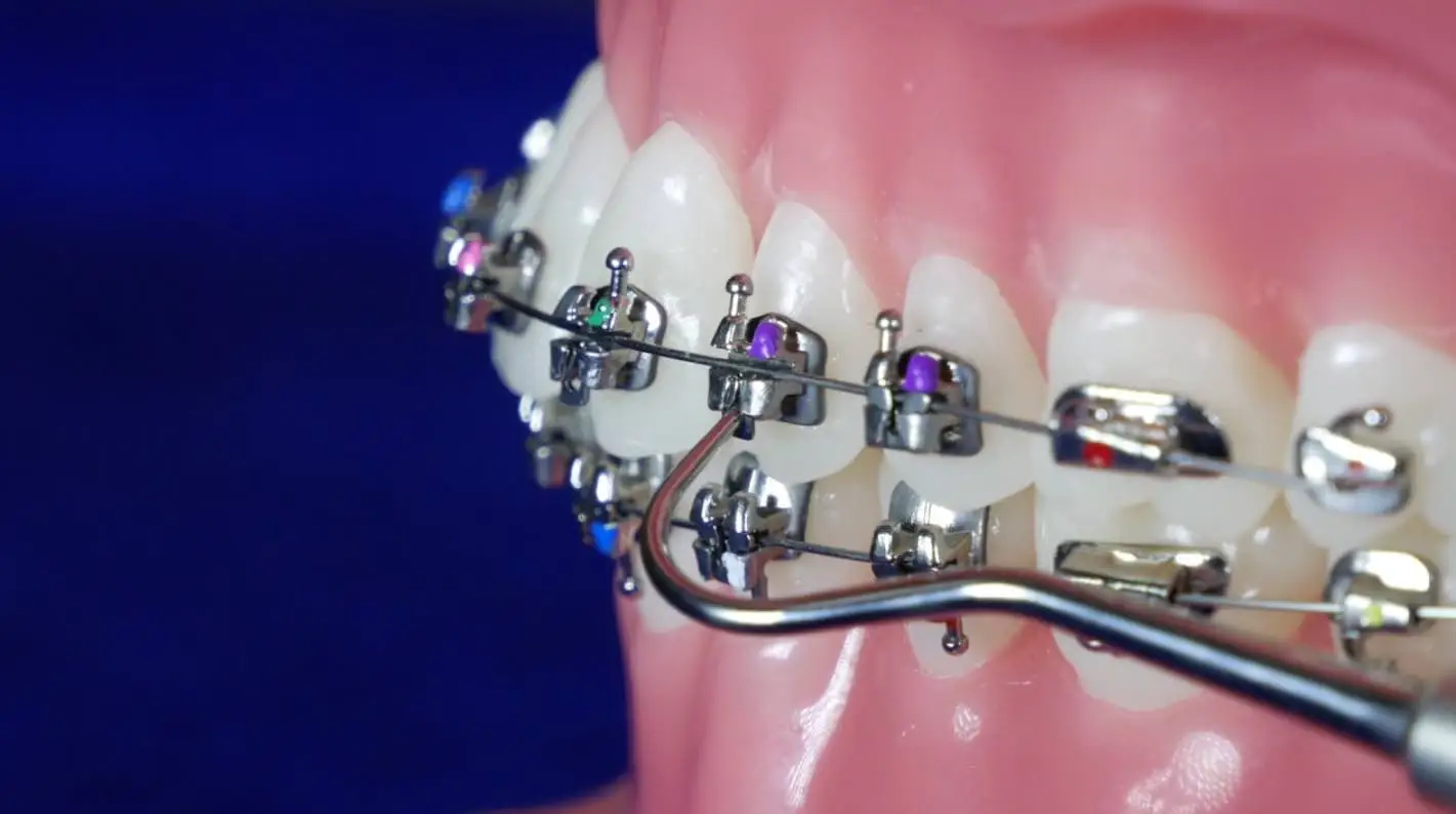 Types of Braces in Malaysia: Which is Right for You | Fresh Dental Clinic